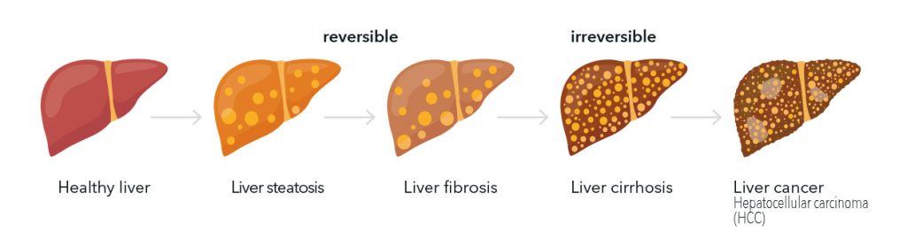 FibroScan® Information for patients - Echosens