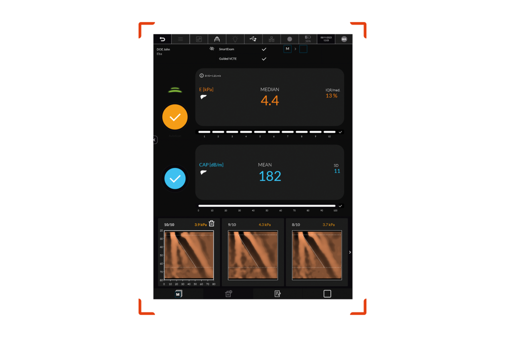 FibroScan® - Facilitated Treatment Options - Echosens