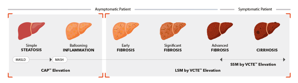 FibroScan® by echosens machine, ultrasound technology, cost - ECHOSENS